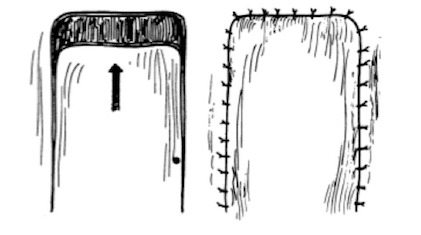 Local Flaps - Dr. Momtazi | Plastic Surgeon, M.D., M.S.c, F.R.C.S.C