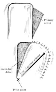 Local Flap Surgery in Ottawa, ON | Skin Cancer Reconstruction